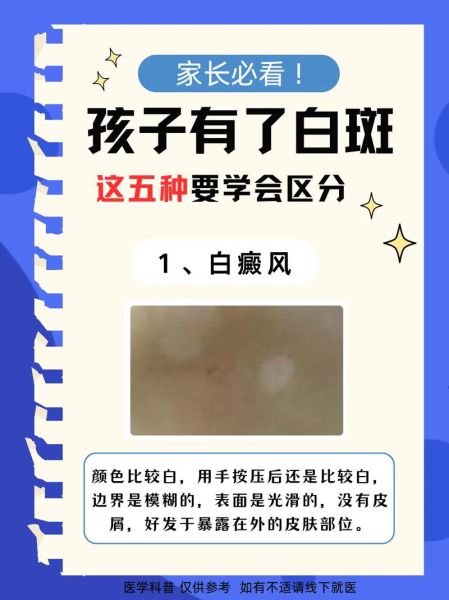 色素减退白斑是怎么造成的_白斑初期症状有哪些-第1张图片-山城妙识