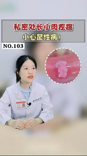 菜花病怎么治疗_菜花病会传染吗-第3张图片-山城妙识