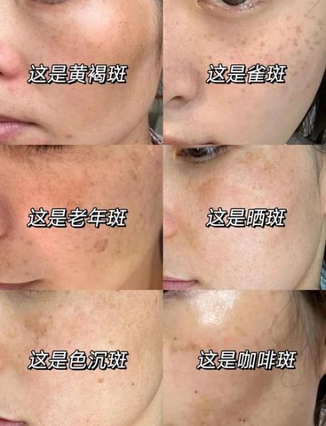脸上色斑怎么去除_色斑图片对照哪种类型-第3张图片-山城妙识