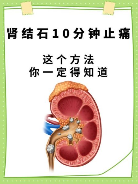 肾结石最快的止痛方法_如何缓解肾结石疼痛-第3张图片-山城妙识