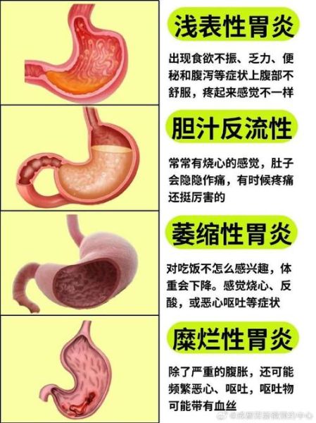 胃炎的症状有哪些_胃炎的表现是什么-第2张图片-山城妙识