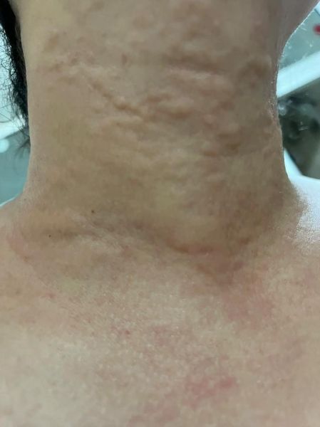 蝉蛹过敏怎么办_蝉蛹过敏症状有哪些-第3张图片-山城妙识