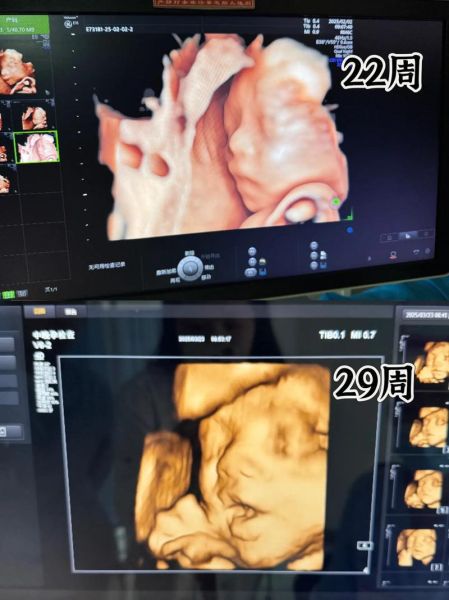 大排畸和四维都要做吗_四维和大排畸区别-第3张图片-山城妙识