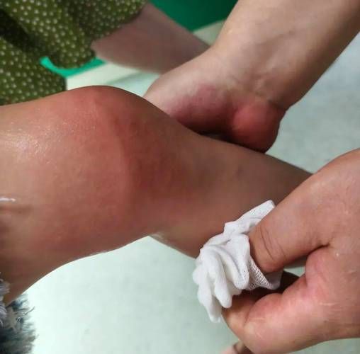 被海蜇咬了什么症状_被海蜇咬了怎么办-第3张图片-山城妙识 被海蜇咬了什么症状_被海蜇咬了怎么办-第3张图片-山城妙识