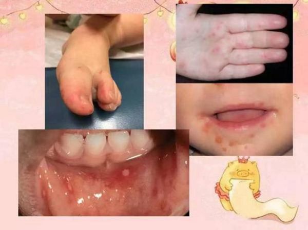 手足口病初期症状图片_如何辨别-第2张图片-山城妙识