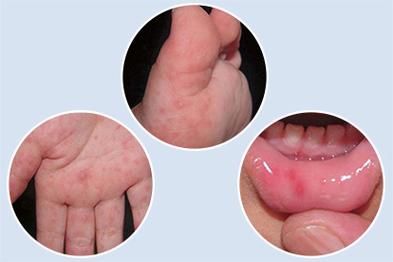 手足口病初期症状图片_如何辨别-第3张图片-山城妙识