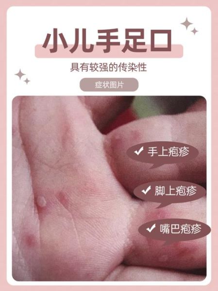 手足口病初期症状图片_如何辨别-第1张图片-山城妙识