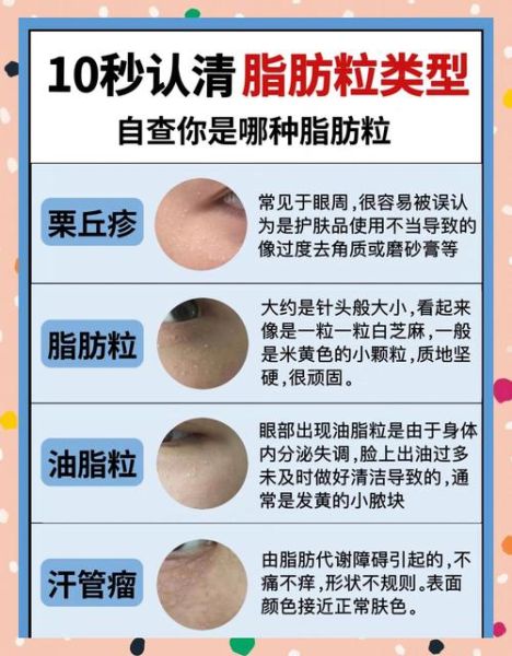 脂肪粒会自己消失吗_脂肪粒多久能消退-第1张图片-山城妙识