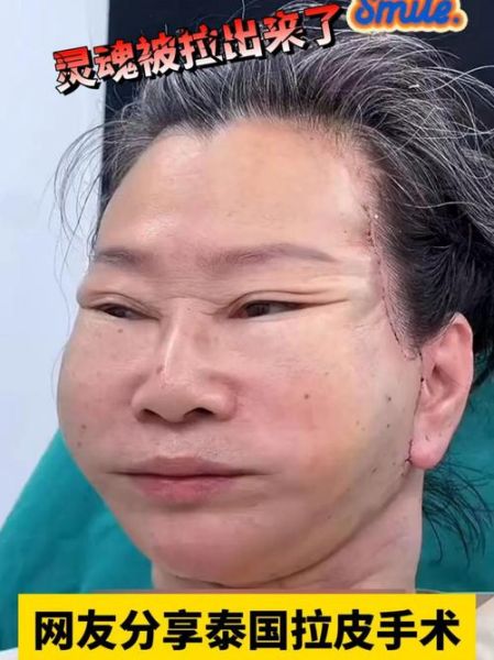 小拉皮手术害了我_小拉皮手术失败怎么办-第3张图片-山城妙识