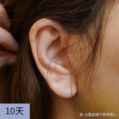 小拉皮手术害了我_小拉皮手术失败怎么办-第2张图片-山城妙识