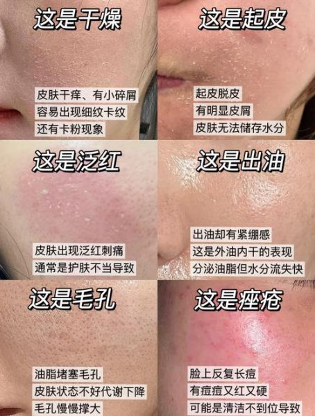 皮肤干燥起皮怎么办_身体干痒脱屑怎么快速缓解-第1张图片-山城妙识