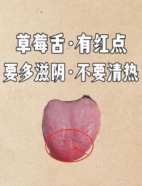 草莓舌怎么治疗_草莓舌多久能好-第1张图片-山城妙识