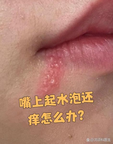 嘴唇上长水泡可以涂红霉素软膏吗_多久能好-第2张图片-山城妙识 嘴唇上长水泡可以涂红霉素软膏吗_多久能好-第2张图片-山城妙识