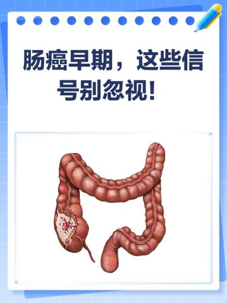 肠癌的早期症状有哪些_肠癌前兆会持续多久-第3张图片-山城妙识