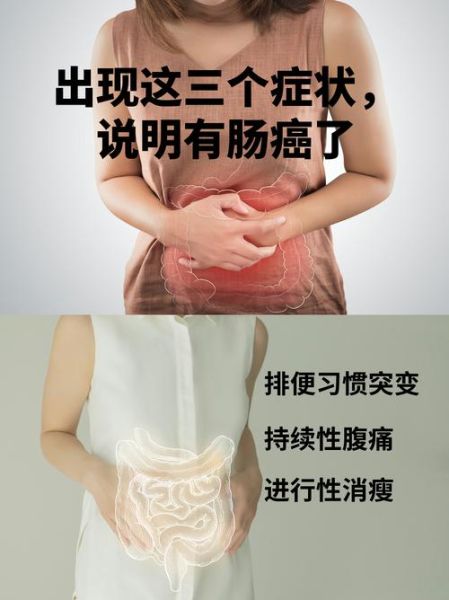 肠癌的早期症状有哪些_肠癌前兆会持续多久-第2张图片-山城妙识