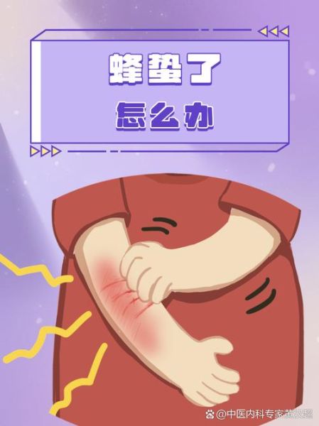 马蜂窝怎么处理最安全_被马蜂蛰了怎么办-第3张图片-山城妙识