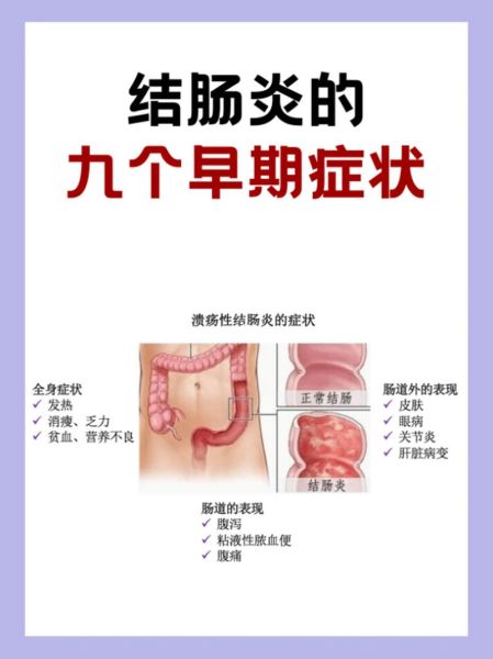 肠炎的症状有哪些_肠炎怎么治疗-第2张图片-山城妙识 肠炎的症状有哪些_肠炎怎么治疗-第2张图片-山城妙识