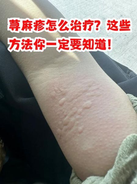 荨麻疹会伴随一辈子吗_慢性荨麻疹能根治吗-第1张图片-山城妙识
