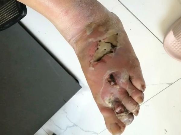 五步蛇咬了多久会死_被咬后黄金抢救时间-第1张图片-山城妙识 五步蛇咬了多久会死_被咬后黄金抢救时间-第1张图片-山城妙识