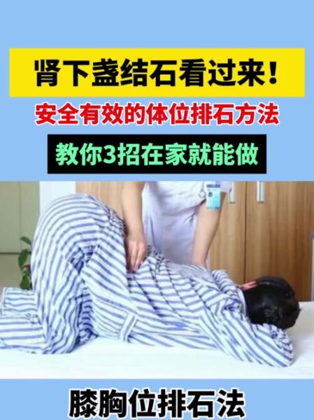 肾结石怎么快速排出_三个动作真的有用吗-第1张图片-山城妙识