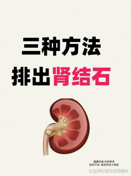 肾结石怎么快速排出_三个动作真的有用吗-第2张图片-山城妙识