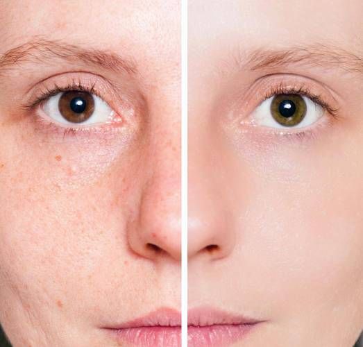 果酸祛痘效果怎么样_果酸换肤去痘印多久见效-第1张图片-山城妙识