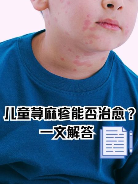 过敏性荨麻疹的症状有哪些_过敏性荨麻疹怎么治疗-第3张图片-山城妙识