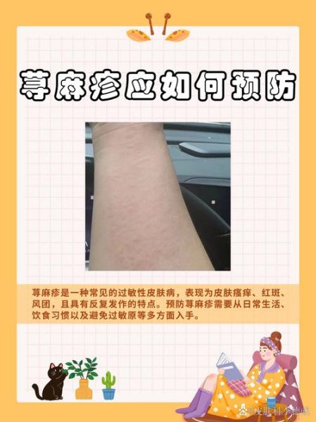 过敏性荨麻疹的症状有哪些_过敏性荨麻疹怎么治疗-第2张图片-山城妙识