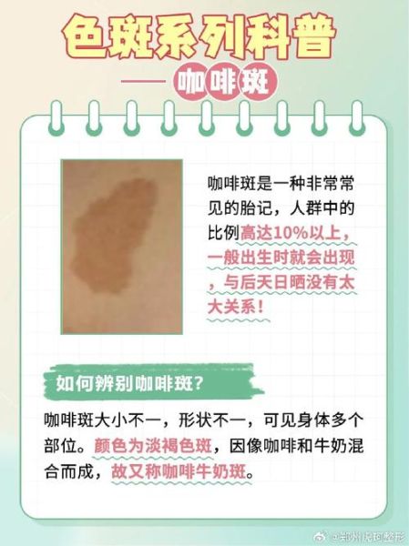 牛奶咖啡斑与胎记区别_如何分辨-第1张图片-山城妙识 牛奶咖啡斑与胎记区别_如何分辨-第1张图片-山城妙识