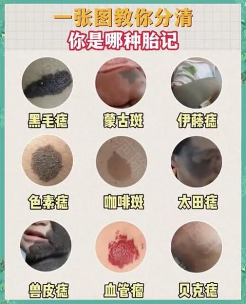牛奶咖啡斑与胎记区别_如何分辨-第3张图片-山城妙识 牛奶咖啡斑与胎记区别_如何分辨-第3张图片-山城妙识