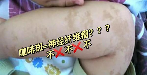 牛奶咖啡斑与胎记区别_如何分辨-第2张图片-山城妙识 牛奶咖啡斑与胎记区别_如何分辨-第2张图片-山城妙识