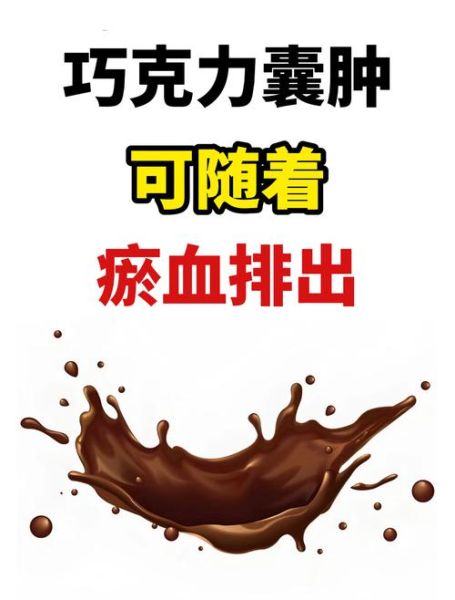 巧克力囊肿如何根治_巧克力囊肿手术后会复发吗-第3张图片-山城妙识