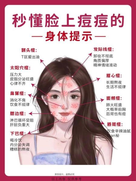 脸上长痘对应五脏示意图_如何调理-第2张图片-山城妙识