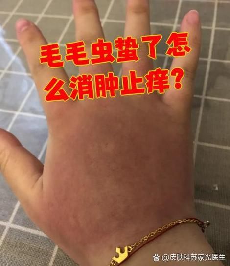 毛毛虫蛰了怎么快速止痒_毛毛虫毒毛过敏怎么办-第1张图片-山城妙识