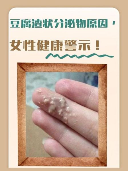 豆腐渣白带是什么妇科病_豆腐渣白带怎么治疗-第2张图片-山城妙识