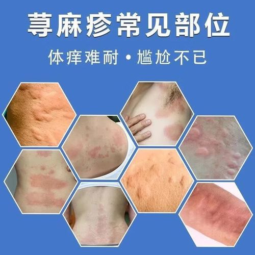 皮肤过敏吃什么药效果最好_抗过敏药怎么选-第2张图片-山城妙识 皮肤过敏吃什么药效果最好_抗过敏药怎么选-第2张图片-山城妙识