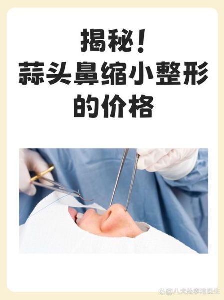 蒜头鼻整形多少钱_蒜头鼻整形价格影响因素-第2张图片-山城妙识 蒜头鼻整形多少钱_蒜头鼻整形价格影响因素-第2张图片-山城妙识