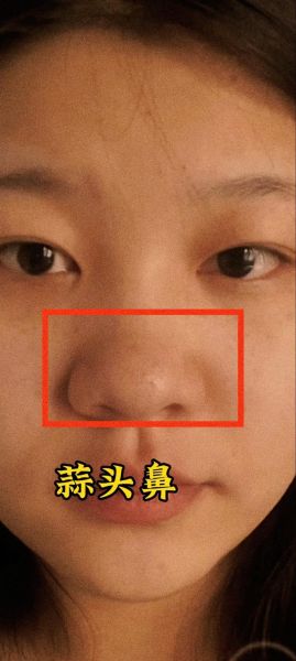 大蒜鼻整容效果图_真实案例-第1张图片-山城妙识