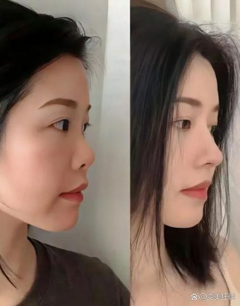 大蒜鼻整容效果图_真实案例-第2张图片-山城妙识