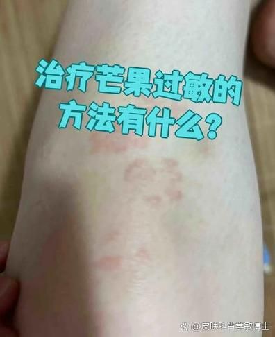 小孩吃芒果过敏怎么办_芒果过敏急救步骤-第3张图片-山城妙识 小孩吃芒果过敏怎么办_芒果过敏急救步骤-第3张图片-山城妙识