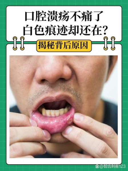 口腔溃疡白色假膜能不能刮掉_棉签刮除后多久能好-第1张图片-山城妙识 口腔溃疡白色假膜能不能刮掉_棉签刮除后多久能好-第1张图片-山城妙识
