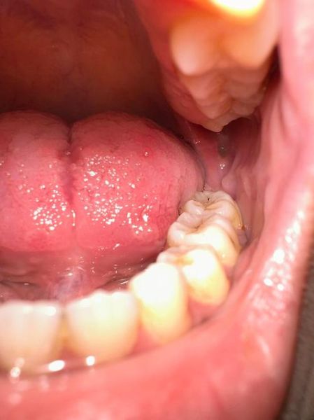 口腔溃疡白色假膜能不能刮掉_棉签刮除后多久能好-第3张图片-山城妙识 口腔溃疡白色假膜能不能刮掉_棉签刮除后多久能好-第3张图片-山城妙识