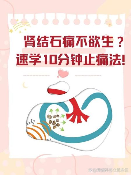 肾结石怎么办_肾结石怎么快速止痛-第2张图片-山城妙识