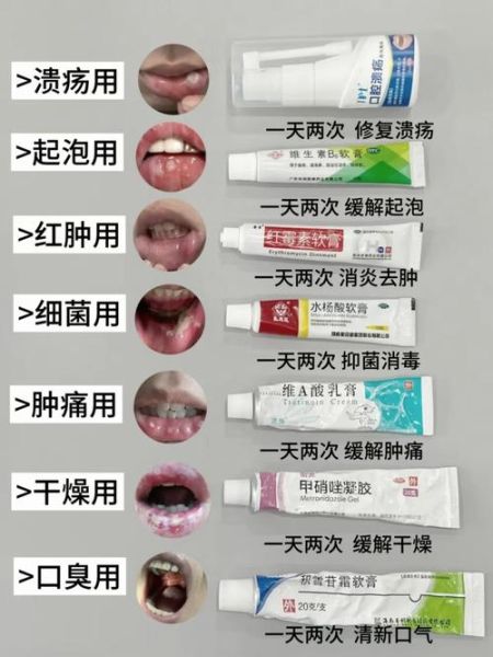 口腔溃疡怎么快速好_一夜治好的克星是什么-第1张图片-山城妙识