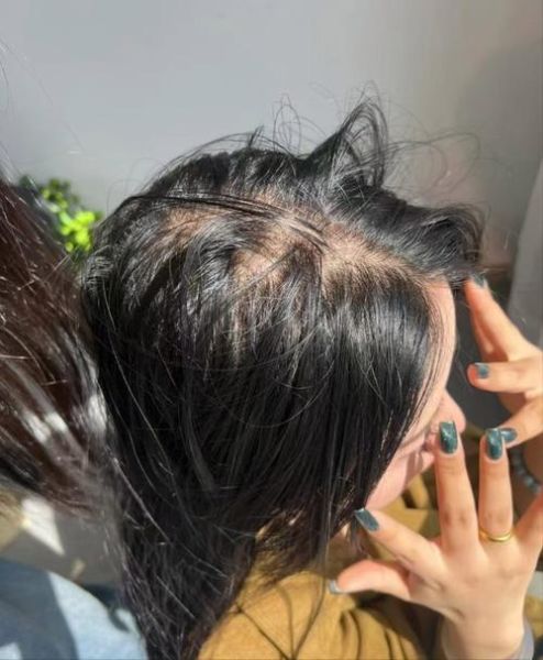 头发稀少怎么补救_头发稀少用什么药效果好-第3张图片-山城妙识 头发稀少怎么补救_头发稀少用什么药效果好-第3张图片-山城妙识