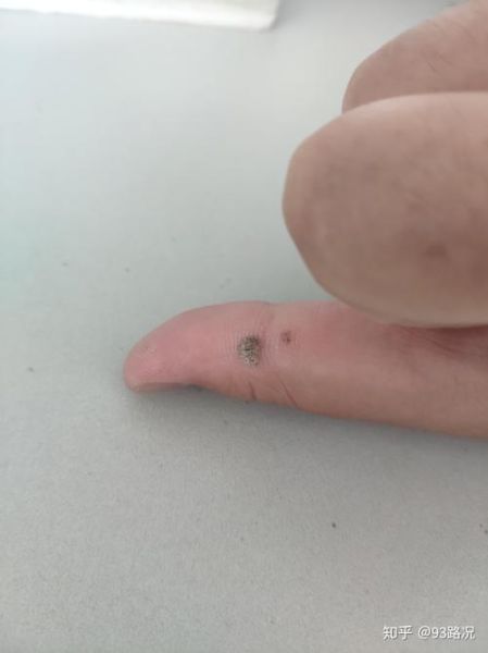 9度米醋治疣步骤_9度米醋去疣多久见效-第3张图片-山城妙识 9度米醋治疣步骤_9度米醋去疣多久见效-第3张图片-山城妙识