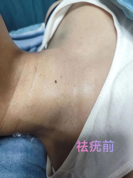 9度米醋治疣步骤_9度米醋去疣多久见效-第1张图片-山城妙识 9度米醋治疣步骤_9度米醋去疣多久见效-第1张图片-山城妙识