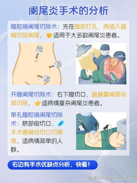 阑尾炎一定要手术吗_不手术会怎样-第2张图片-山城妙识 阑尾炎一定要手术吗_不手术会怎样-第2张图片-山城妙识