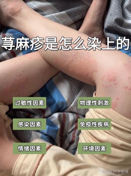 荨麻疹怎么判断_荨麻疹初期症状有哪些-第1张图片-山城妙识 荨麻疹怎么判断_荨麻疹初期症状有哪些-第1张图片-山城妙识