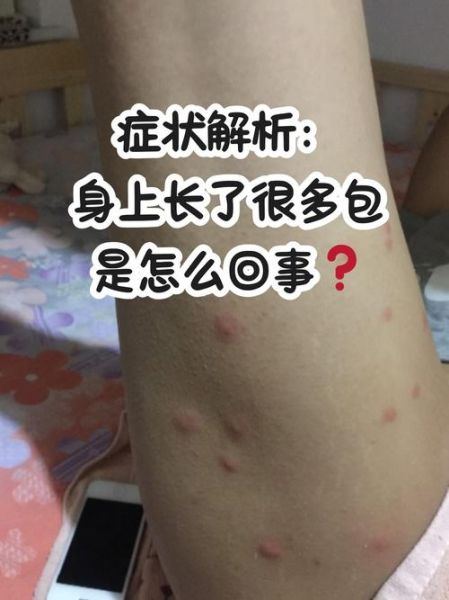 荨麻疹怎么判断_荨麻疹初期症状有哪些-第3张图片-山城妙识 荨麻疹怎么判断_荨麻疹初期症状有哪些-第3张图片-山城妙识